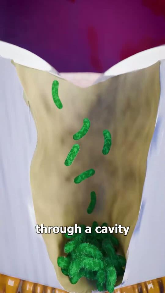 How A Tooth Abscess Develops Newsbreak 5511