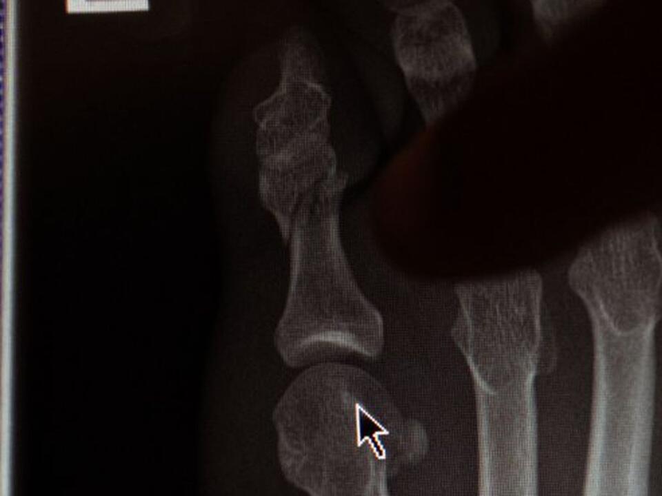 Conor McGregor posts X-ray of broken pinky toe, mercilessly mocked by ...