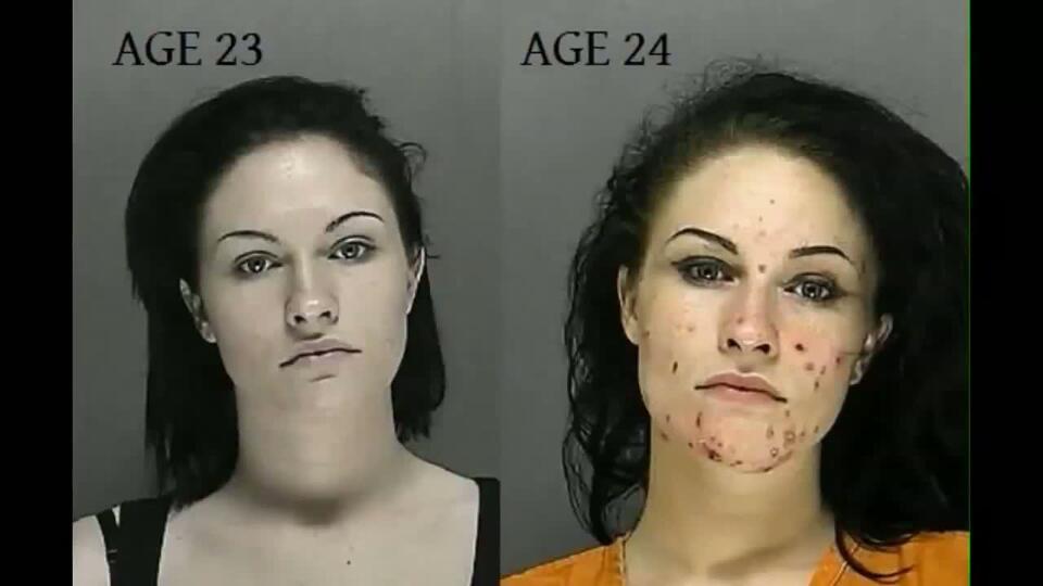 Before & After: The Shocking Transformation of Meth Users 😲 # ...
