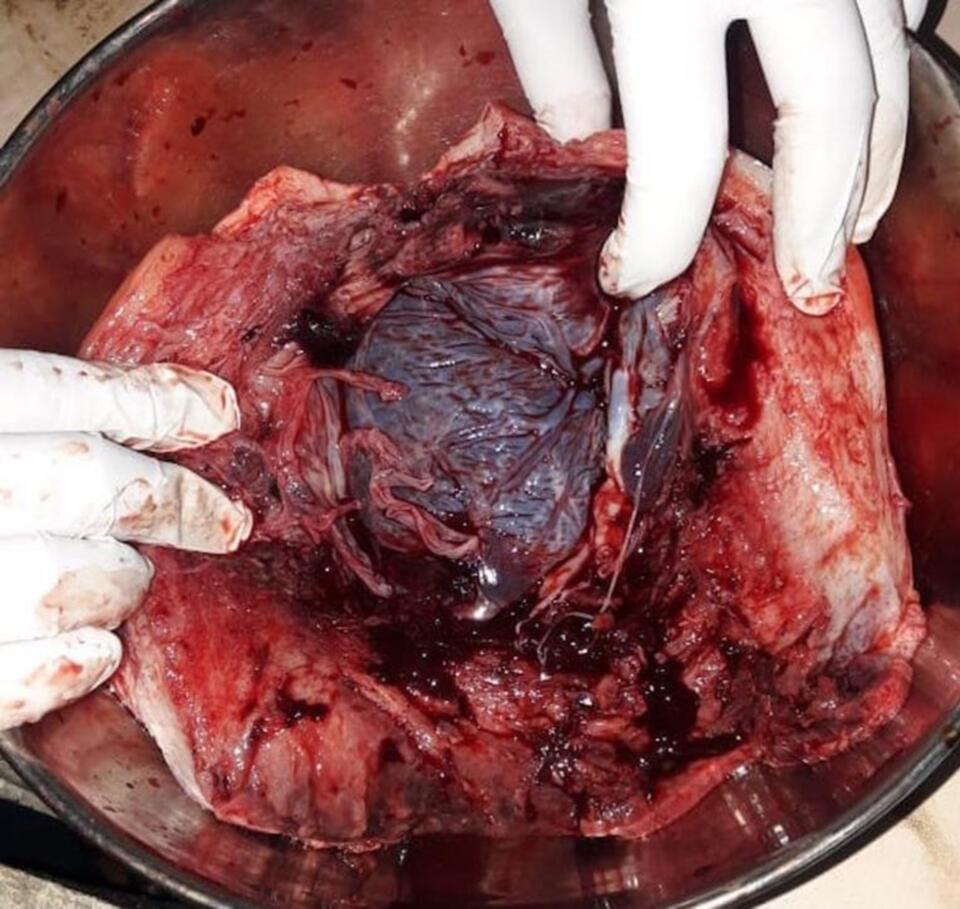 Unexpected placenta accreta spectrum in an unscarred uterus causing ...
