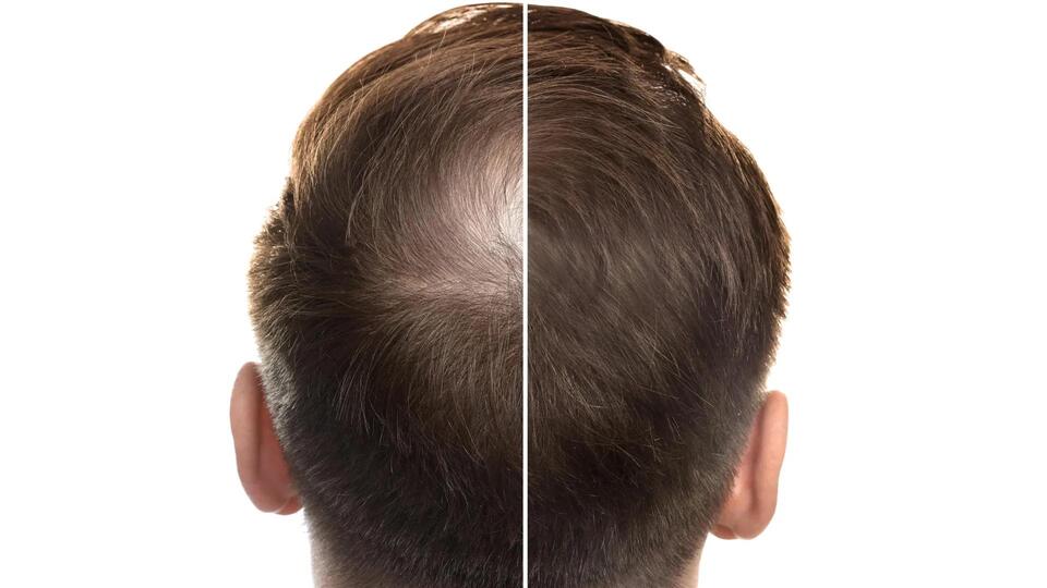 A sweet fix for baldness? Stevia compound boosts hair growth - NewsBreak