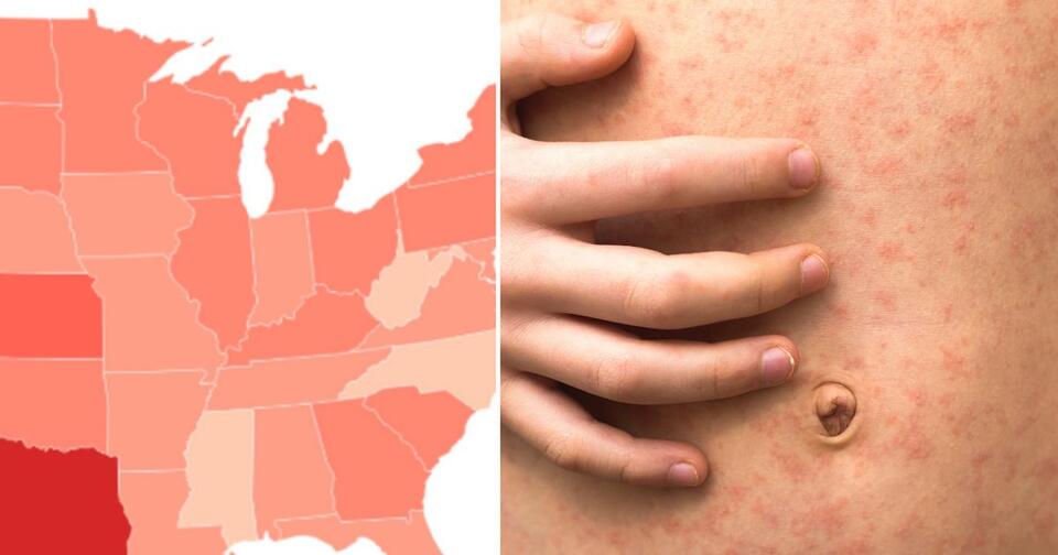 The state with the highest number of measles cases as data shows ...