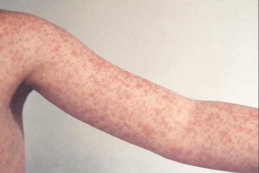 2 new measles cases in Buncombe County. About 100 people are now under ...