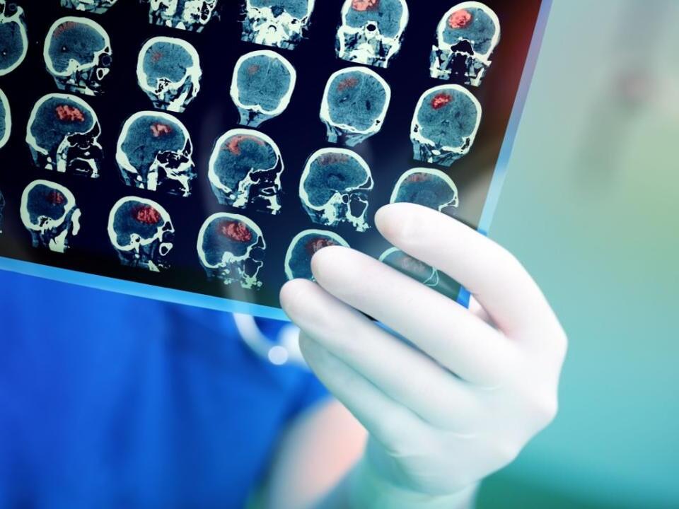 Where strokes are the most common in Connecticut