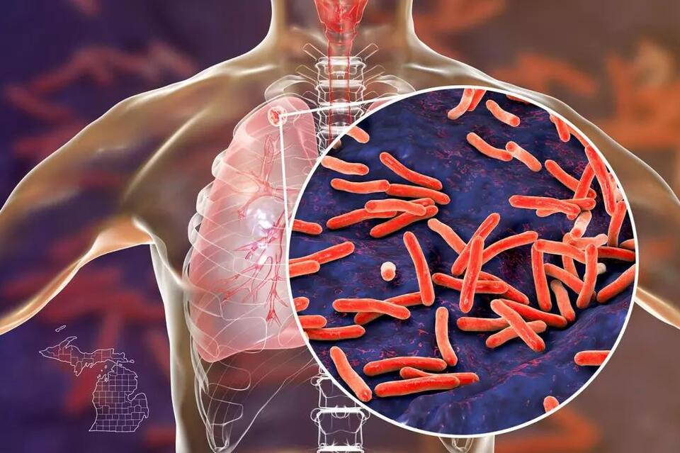 Health Officials Investigate Tuberculosis Case in Michigan School ...