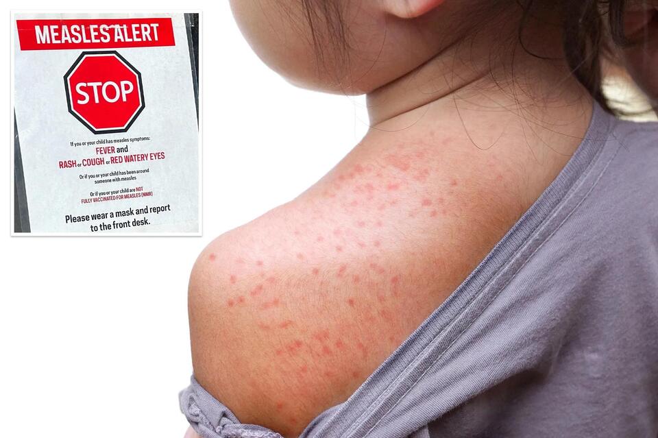 Massive measles outbreak shows signs of slowing down as cases explode ...
