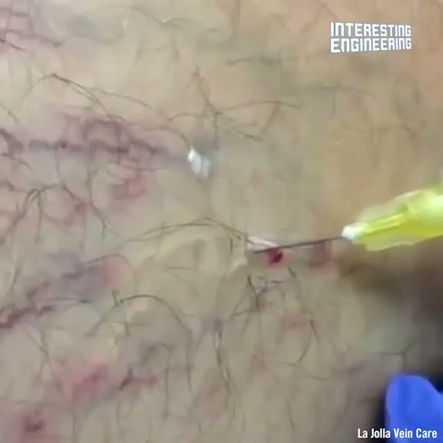 This treatment could help reduce the appearance of spider veinsvia ...