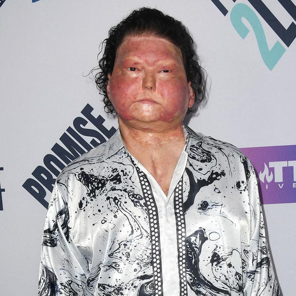 TikToker Joe DiMeo Details Face Transplant After Being 80 Percent ...
