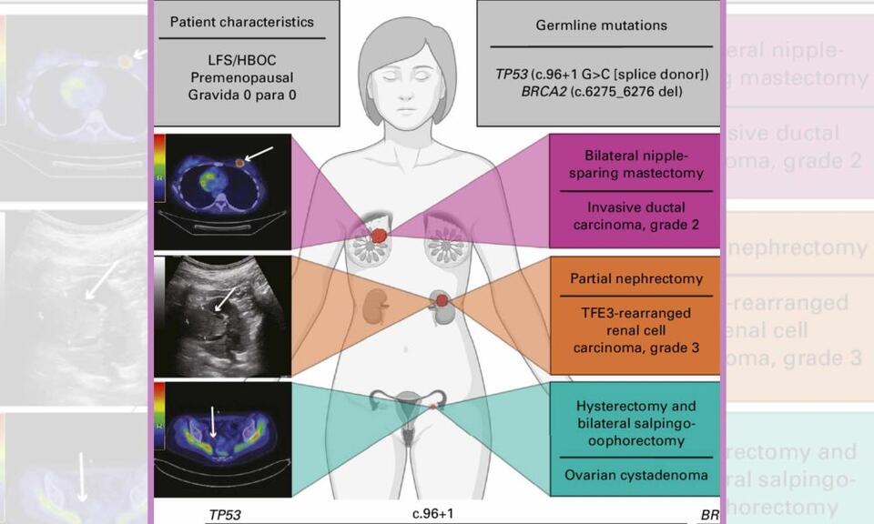 Many women confuse the first symptoms of ovarian cancer with simple ...