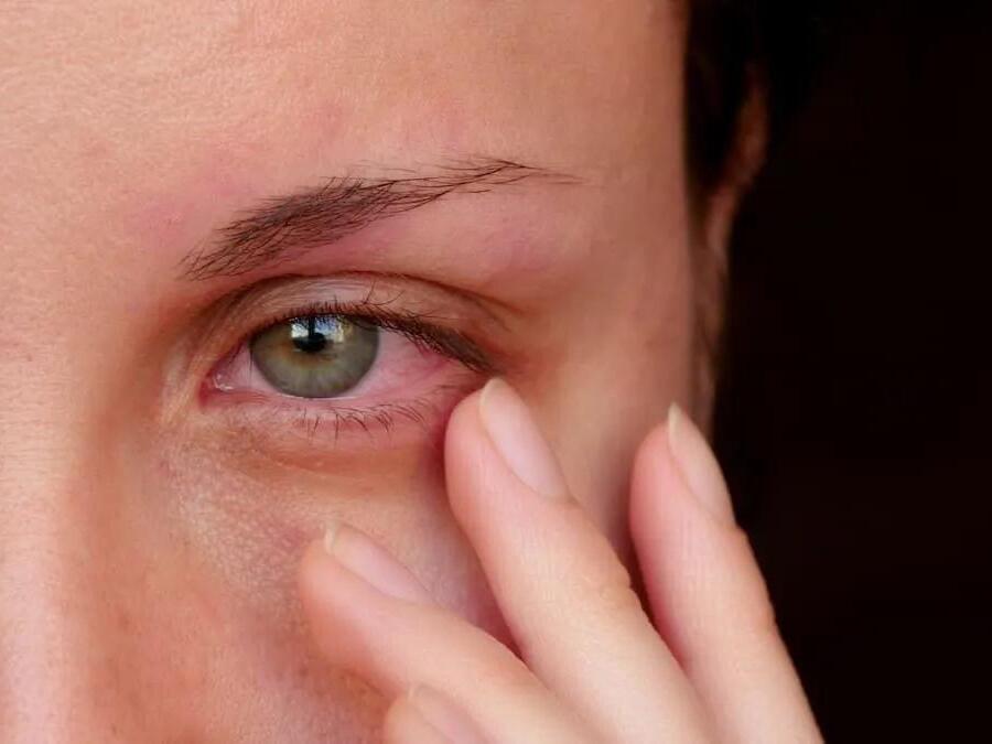 Apolipoprotein E as key biomarker for corneal involvement in infectious ...