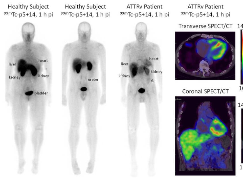Groundbreaking images reveal ‘Alzheimer’s disease of the heart’