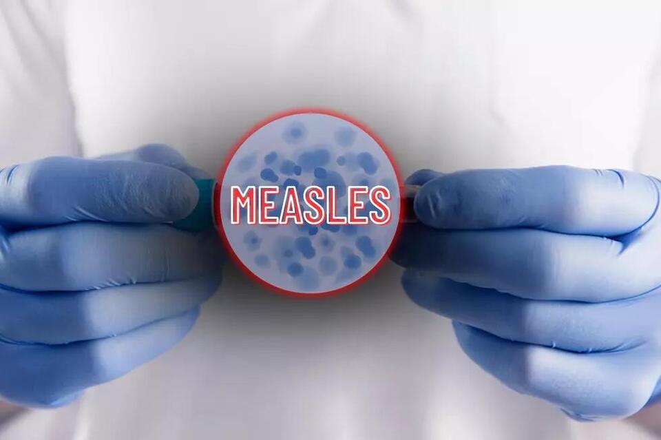 Brand New Measles Case Confirmed, See All the Locations in WA So Far ...
