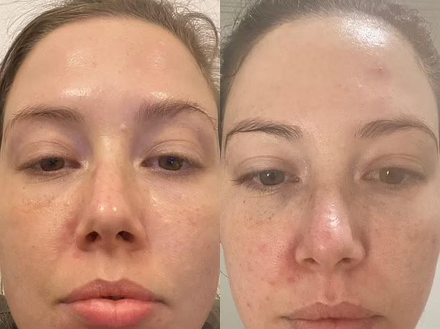 The Secret skincare: Woman reveals how she transformed her acne-prone ...