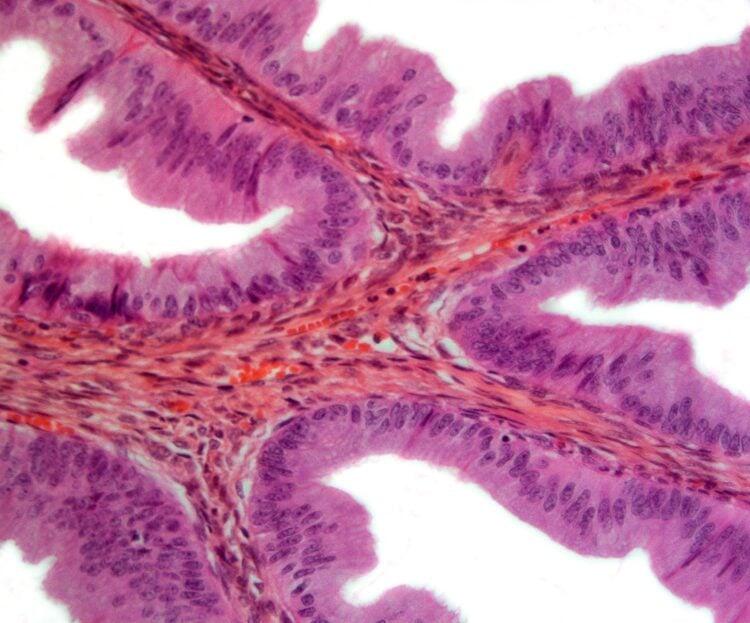 Are Nasal Polyps Cancerous? Here’s What You Should Know, Says an Expert ...