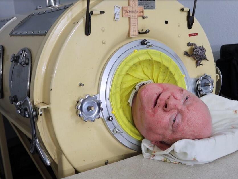 Paul Alexander ‘Polio Paul’ Who Lived In Iron Lung For 70 Years, Dies At 78