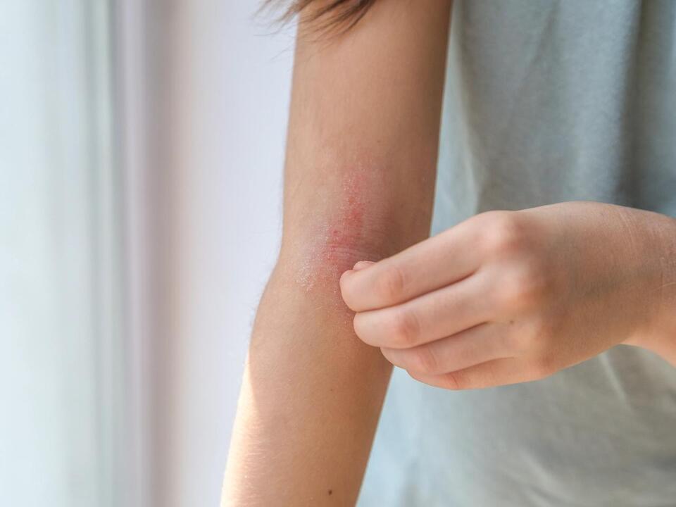 Dealing with mite bites? Local doctors share how to get relief