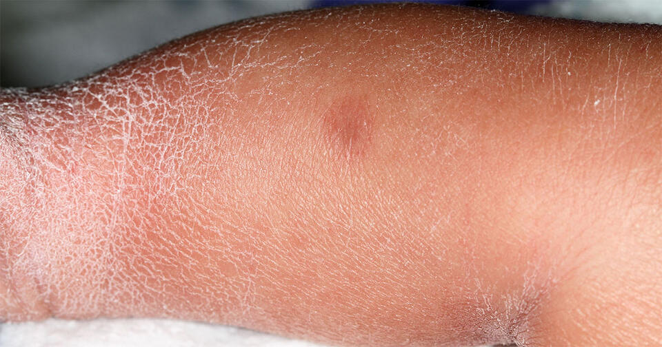 Newborn presents with desquamation, red spots on limbs after home birth ...