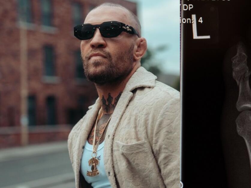 Photos – Conor McGregor reveals fractured toe injury in x-Ray images ...