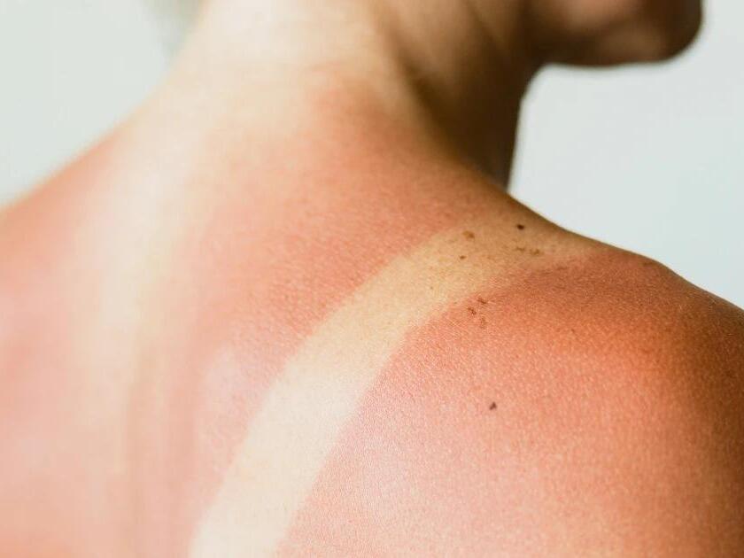 Do you have heat rash or sun poisoning? Look for these important ...