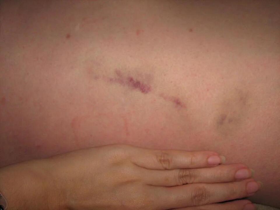 8 Reasons for Easy Bruising and How to Prevent Them - NewsBreak