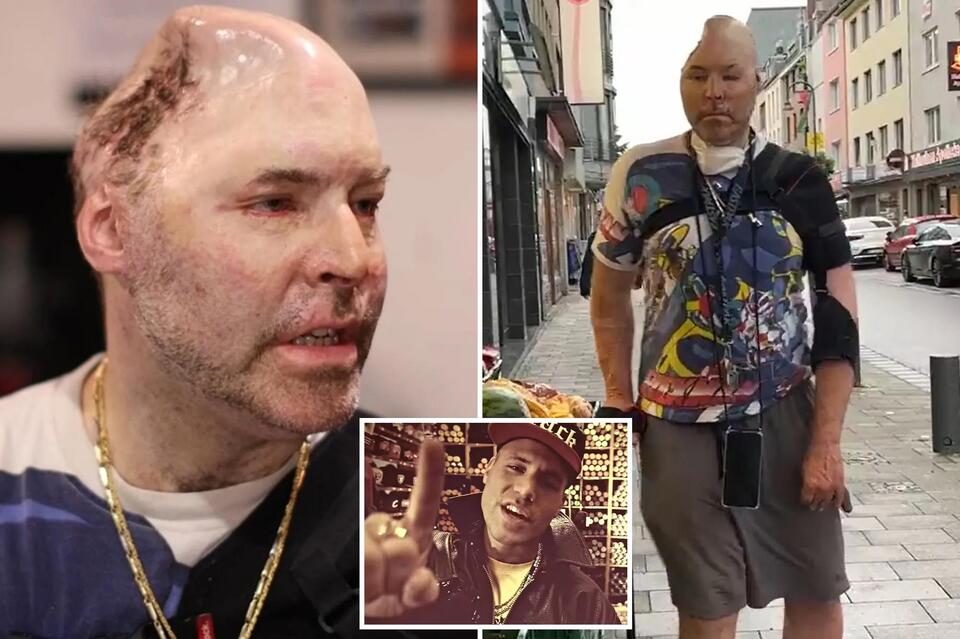 Rapper who lost half his skull in ‘Nazi gold’ drug lab explosion ...