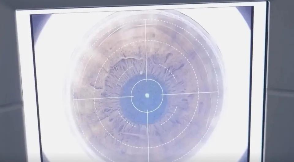Eye color surgery that permanently changes your appearance is growing ...