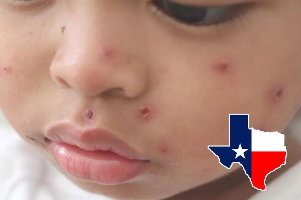 Texas Measles Outbreak Officially Now The Worst In 30 Years - NewsBreak