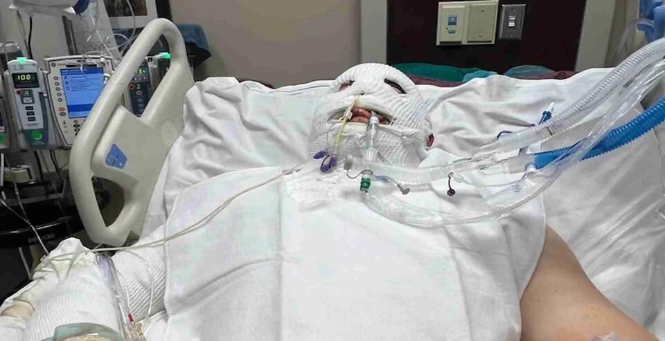 Man Severely Burned And In Coma After Backyard Bonfire Gone Wrong ...