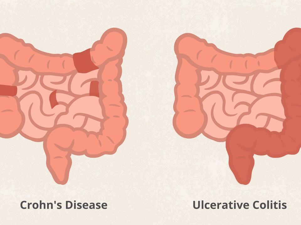 Crohn's Disease Versus Ulcerative Colitis: What's the Difference?