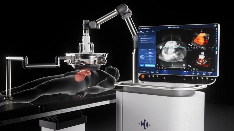 World’s First Patients Treated With Novel Edison® Histotripsy System ...