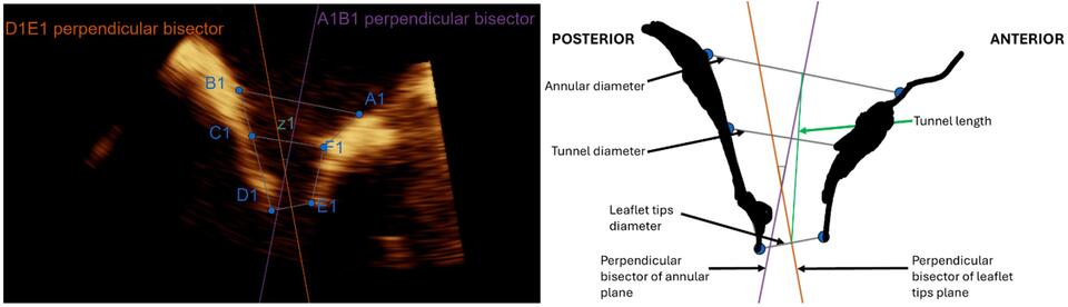 Two Faces of Mitral Stenosis: Uncovering Structural and Hemodynamic ...