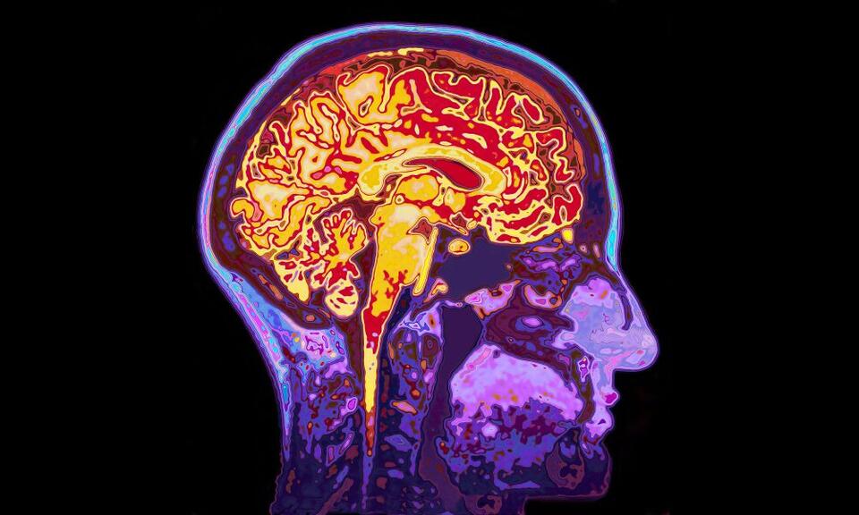Disturbing study finds microplastic accumulation in human brains ...