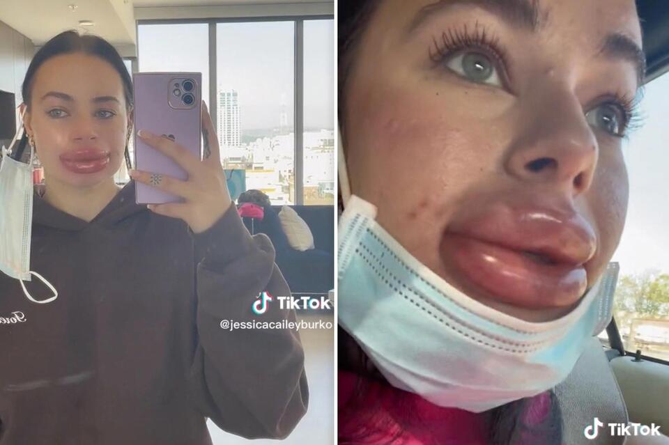 My lip filler was horribly botched — I went through a nightmare - NewsBreak