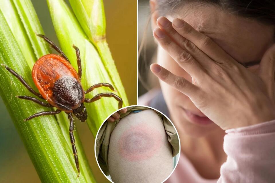 The most common — and scariest — signs you’ve got a tick bite, as ER ...