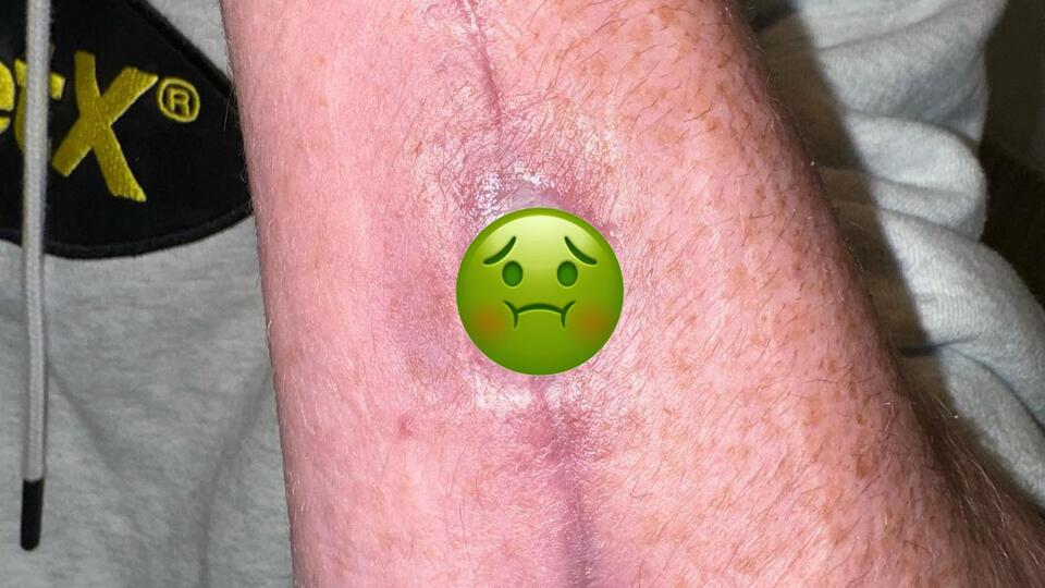 ‘Is this ringworm?’ Mystery infection, additional surgeries boot Jack ...