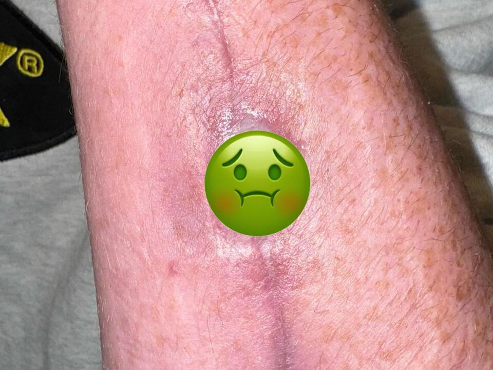 ‘Is this ringworm?’ Mystery infection, additional surgeries boot Jack ...