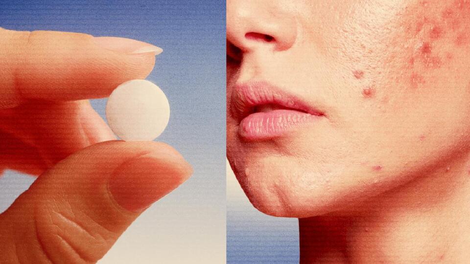 The most popular pill to treat women's acne is a blood pressure drug ...