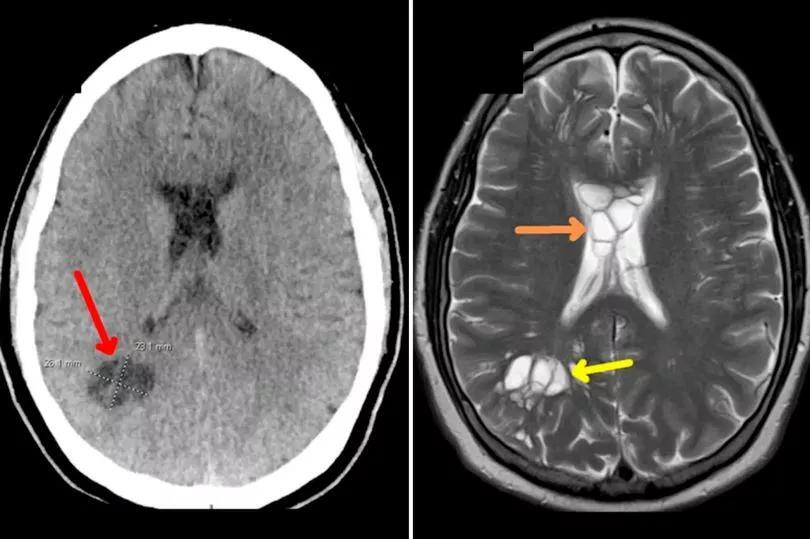 Man who loved 'soft bacon' found to have worm in brain after eating ...