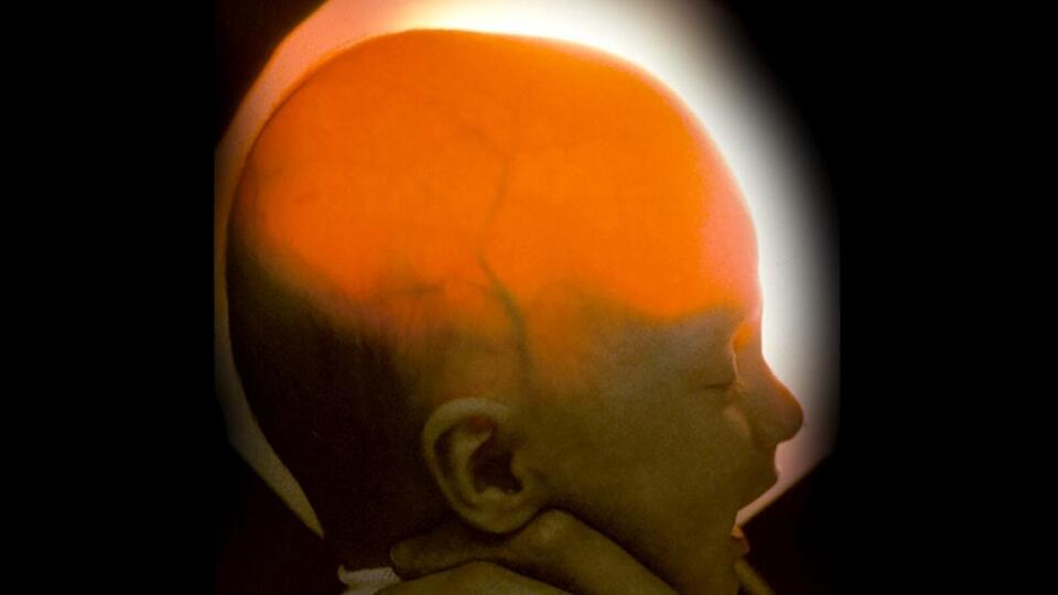 Woman Born Missing Most of Her Brain Just Turned 20, Defying Odds ...
