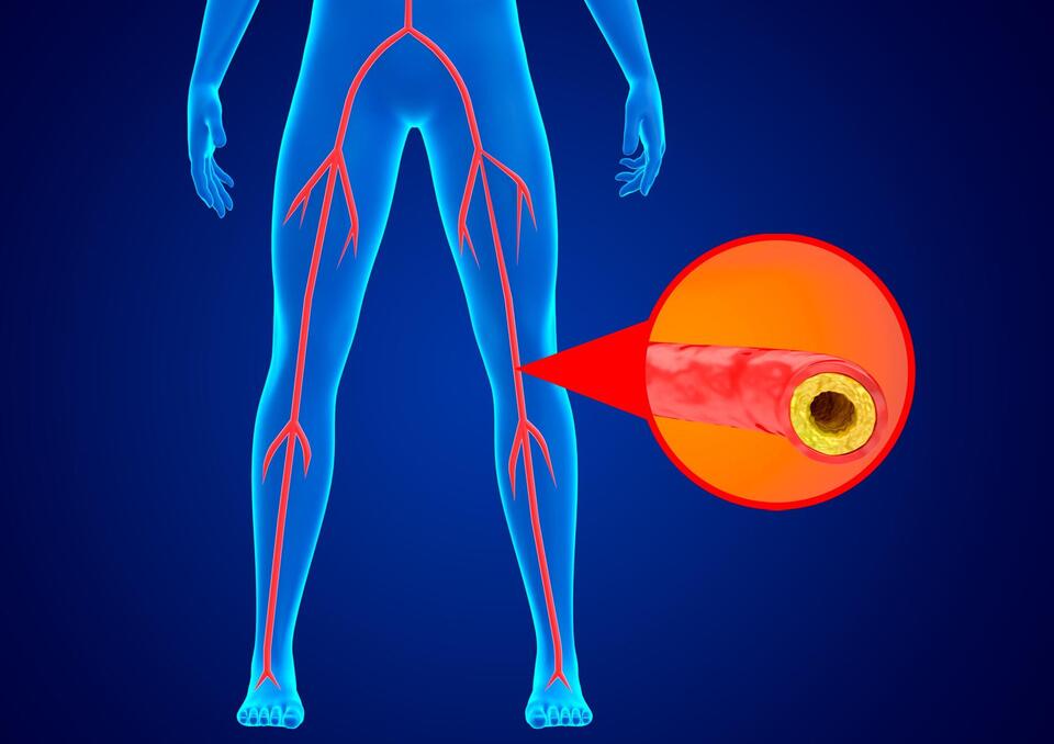 AIROS Medical launches FDA-cleared home compression device for ...