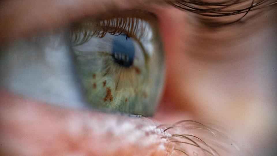 A new test could flag people at risk for anemia by filming their ...