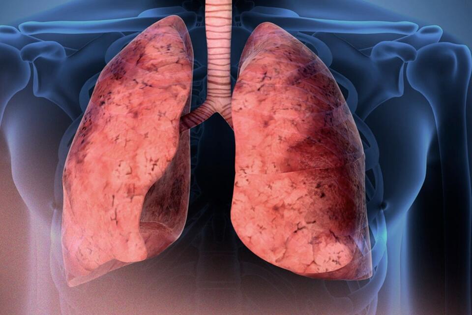 20 Facts About Kartagener’s Syndrome - NewsBreak