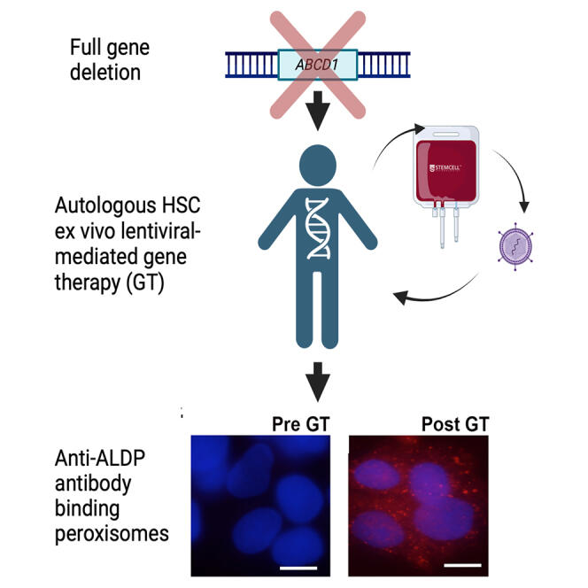 Secondary failure of lentiviral vector gene therapy in a cerebral ...
