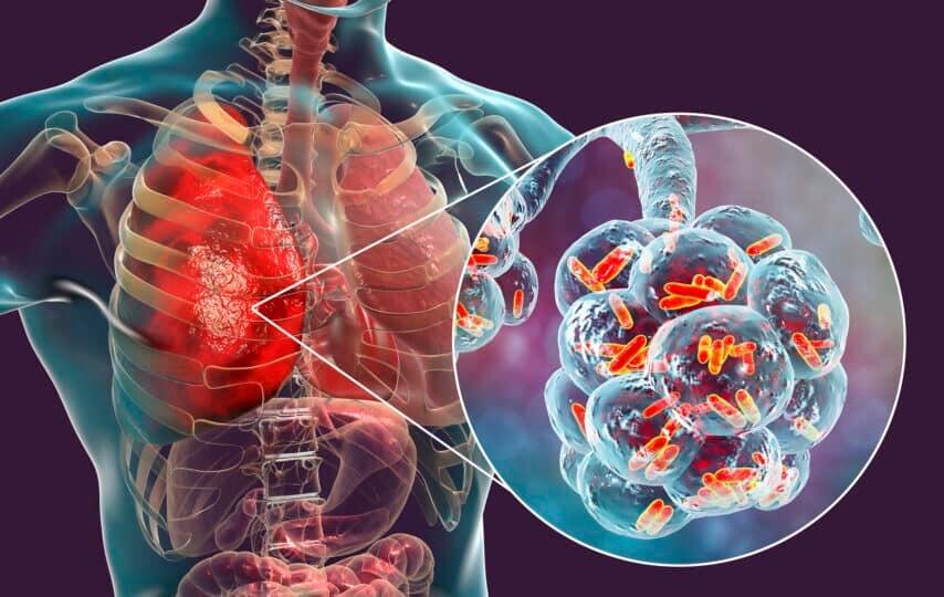 Pneumonia in elderly adults: What causes it, symptoms, and everything ...