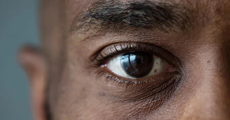 Visual acuity improved less in Black patients vs. white with Lucentis ...