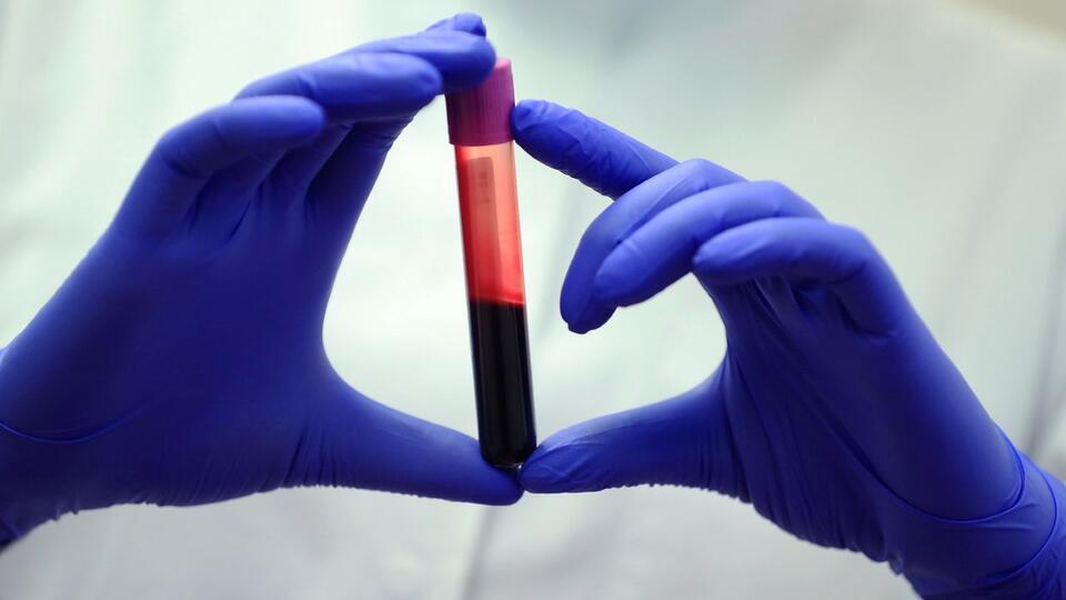 New blood test aims to spot liver scarring before it paves the way to ...