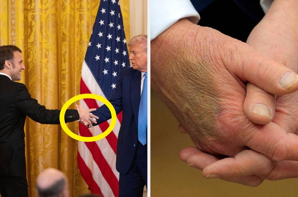 Donald Trump's Bruised Hand Is Going Viral, And The White House Had An ...