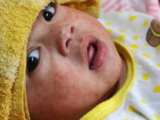 Potential measles case under investigation by county health department