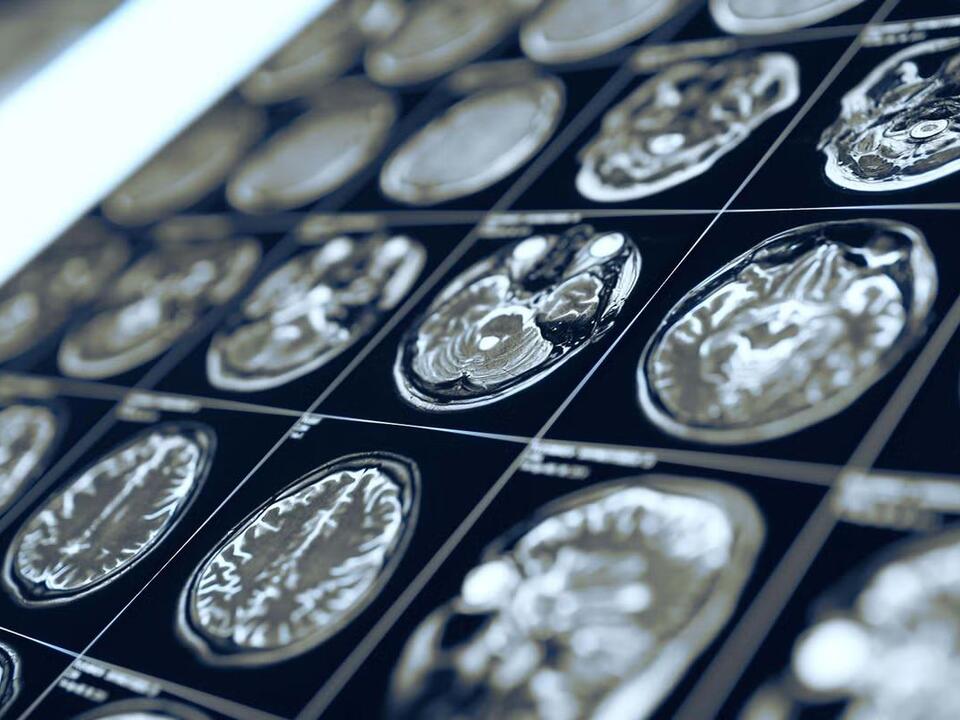 MRI scans reveal the damage long Covid does to your brain