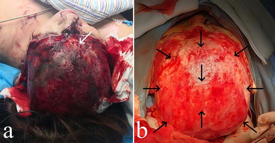 Treatment of severe scalp avulsion injury through microsurgical ...